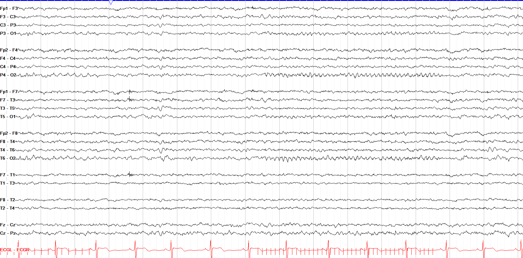 Normal Eeg Tracing
